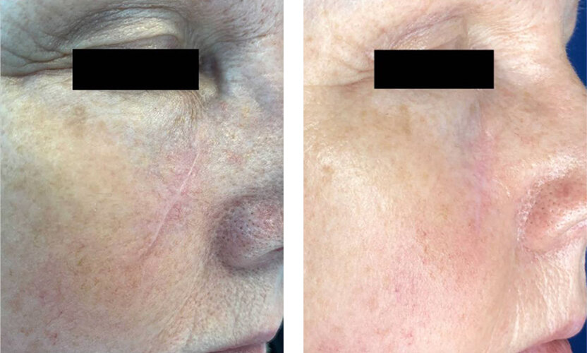 Narbenbehandlung | blutungsfrei und schmerzarm